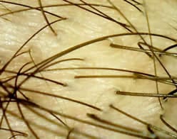 Anorexia Hair Loss men women | Holborn Hair & Scalp Clinic