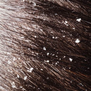 Pityriasis - Specialist scalp advice and treatment Tel Free Advice Line ...