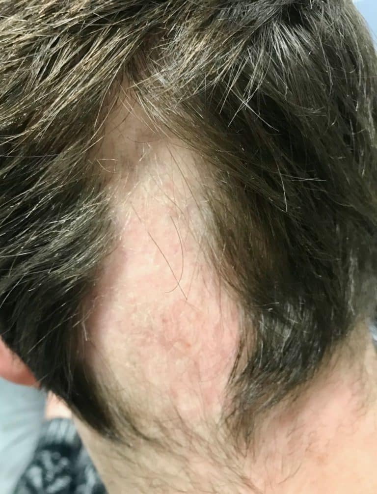 Alopecia Areata | Symptoms & Treatments | Holborn Clinic