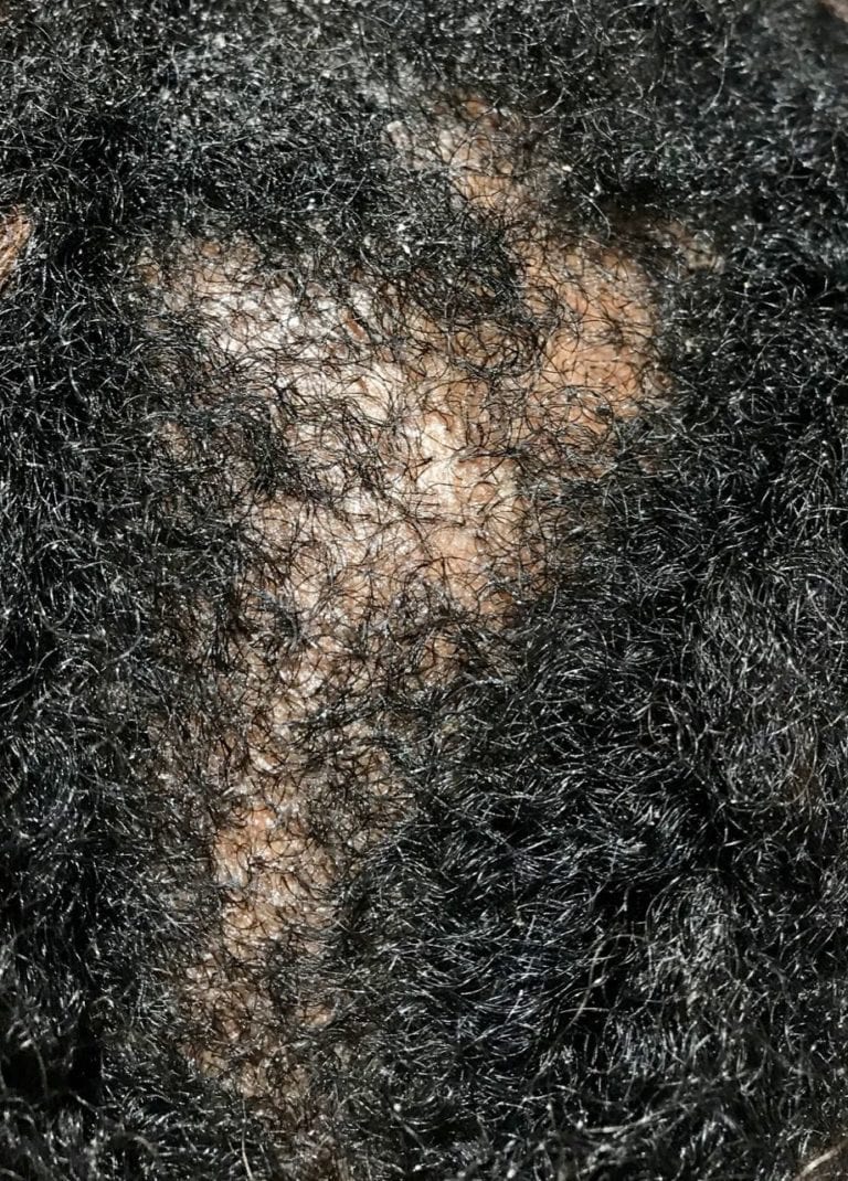 Dandruff | Conditions & Treatment | Holborn Hair Clinic