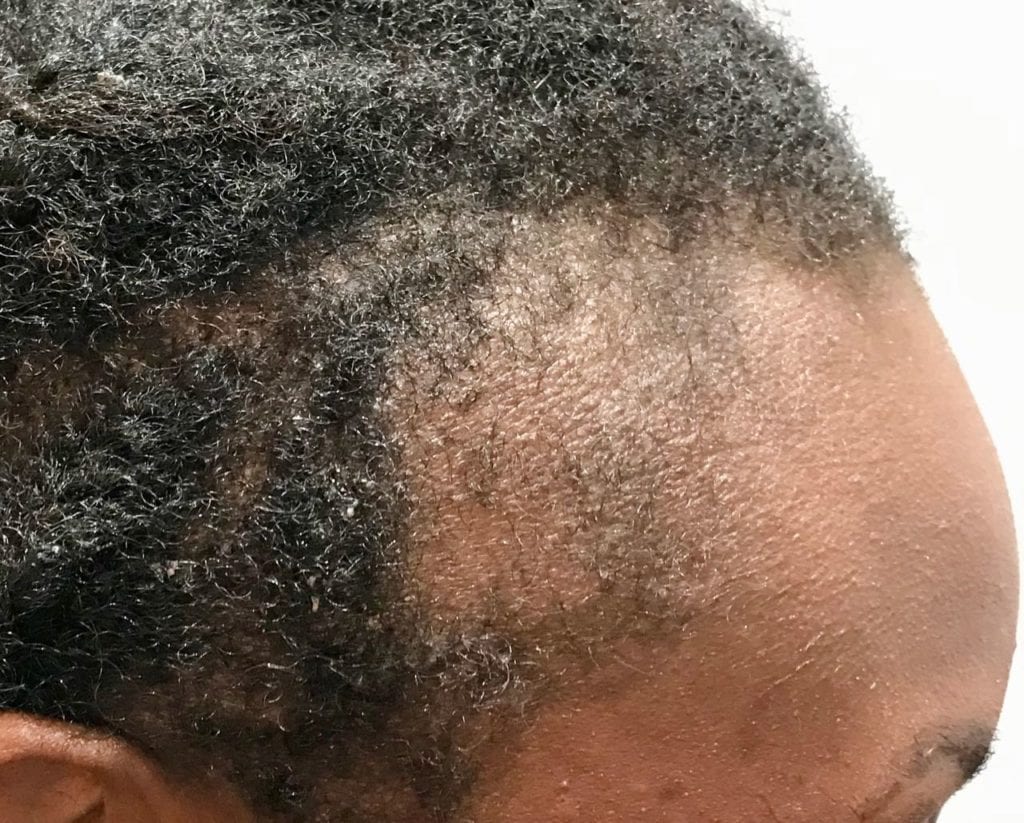 Afro Hair Transplant | Holborn Hair Scalp Clinic | Price from £2000