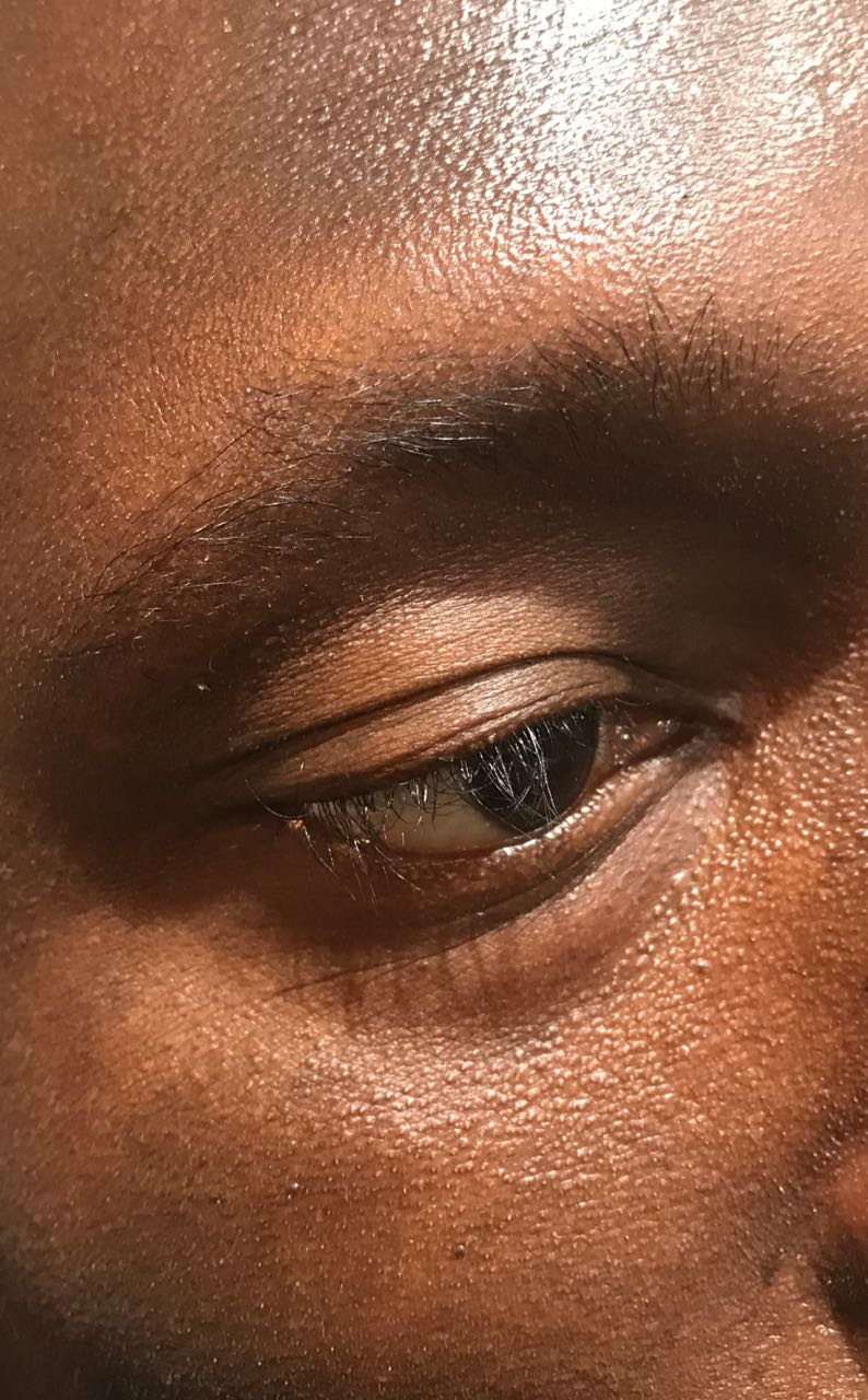 Eyebrow Transplants | Holborn Hair Scalp Clinic London