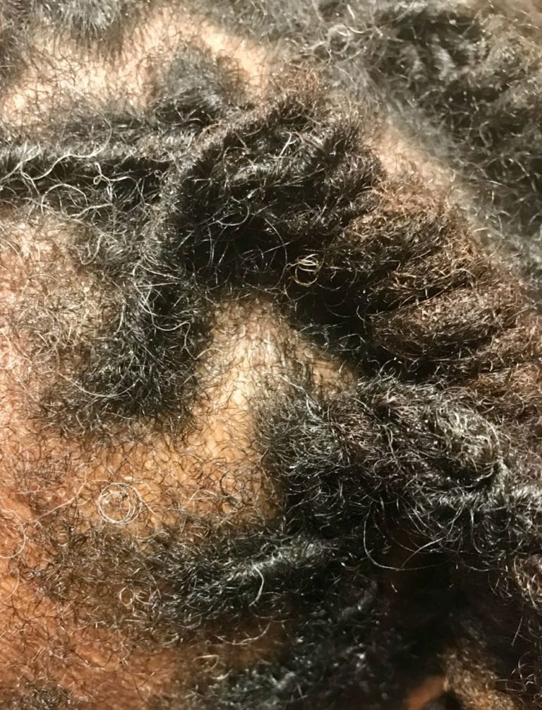 Afro Scalp Cleansing - Remove the itchy dry flaky scalp